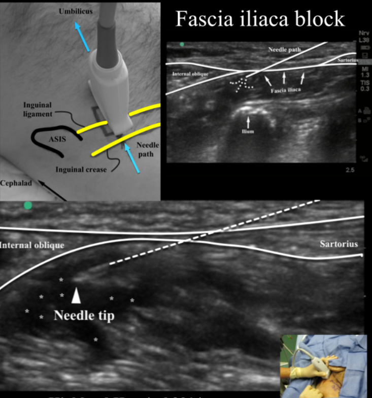 Fascia Iliaca Block — Kwak Talk