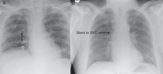 Central Lines: Tips You Can't Miss — Kwak Talk