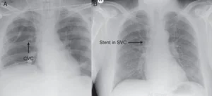 Central Lines: Tips You Can't Miss — Kwak Talk