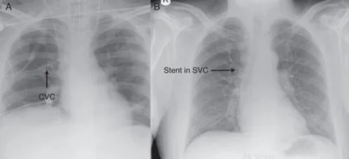 Central Lines: Tips You Can't Miss — Kwak Talk
