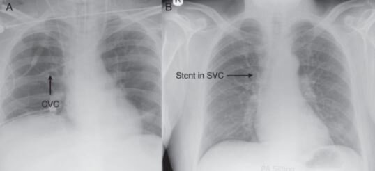 Central Lines: Tips You Can't Miss — Kwak Talk