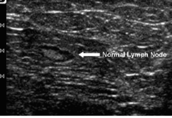 Evaluation of mesenteric adenitis with POCUS in the ED — Kwak Talk