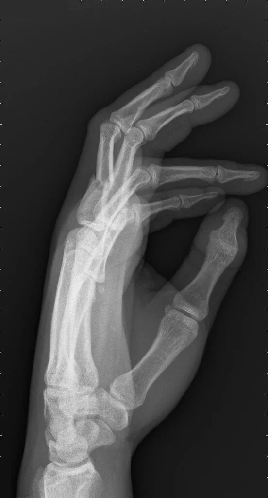 Ortho Case: Finger Injury — Kwak Talk