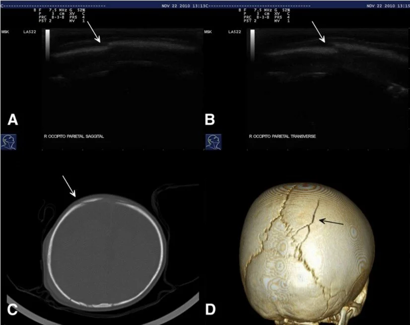 SKULL FRACTURES AND ULTRASOUND — Kwak Talk