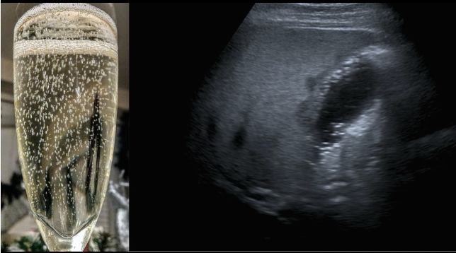 The Gassy Gallbladder — Kwak Talk