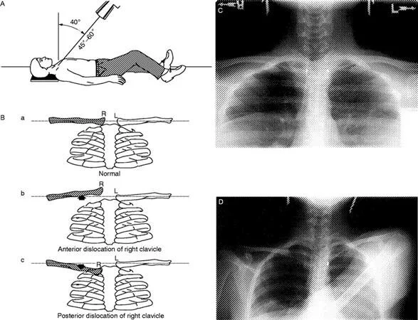 Sternoclavicular Joint Dislocation — Kwak Talk