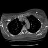 Sternoclavicular Joint Dislocation — Kwak Talk