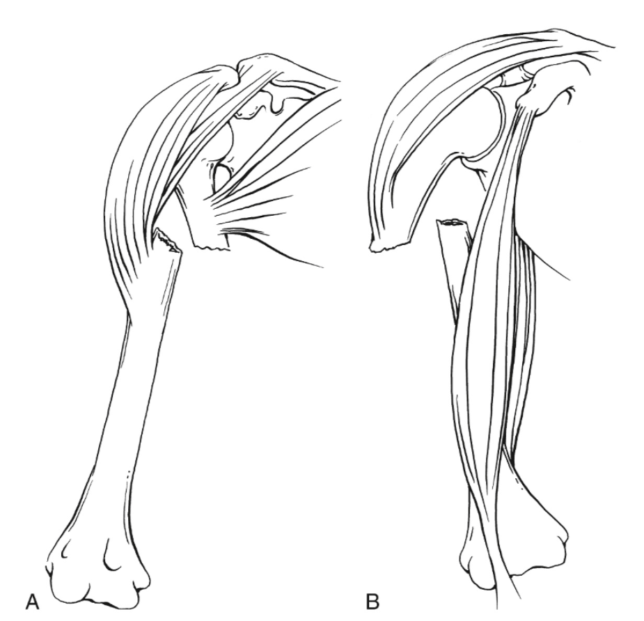 Humeral Shaft Fracture — Kwak Talk