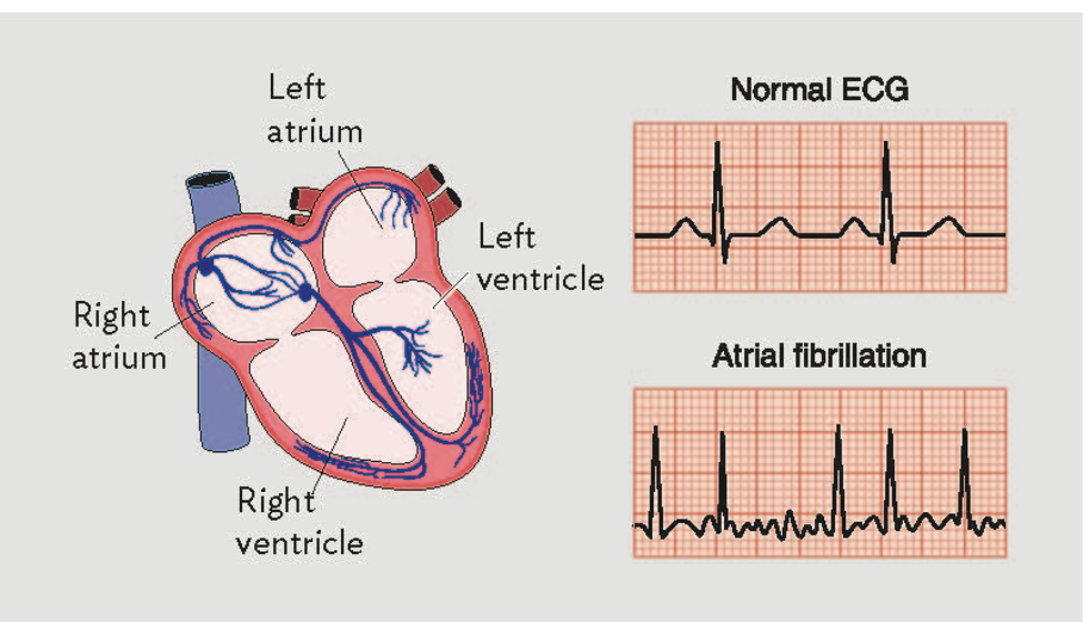 Step by step approach to Afib with RVR — Kwak Talk