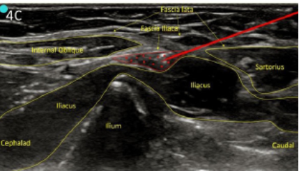 Fascia Iliaca Block — Kwak Talk