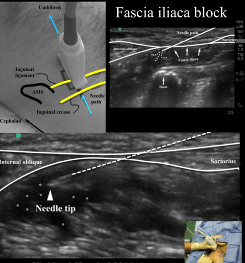 Fascia Iliaca Block — Kwak Talk