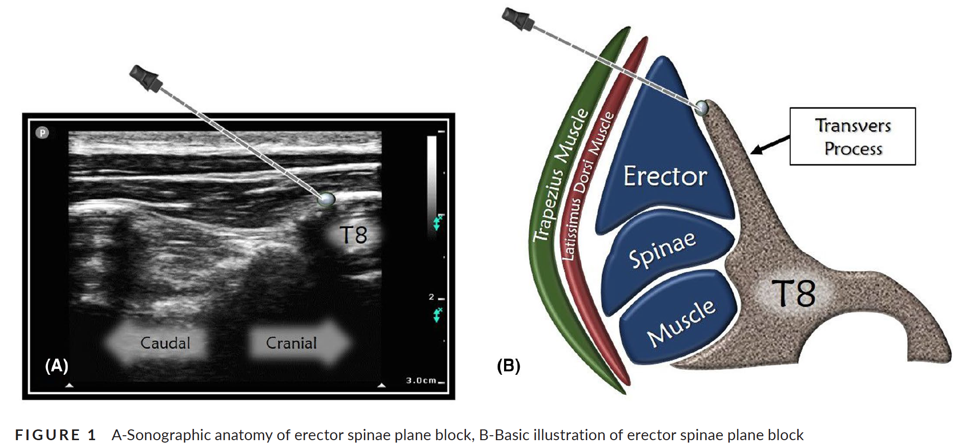 Erector Spinae Nerve Block for Renal Colic — Kwak Talk