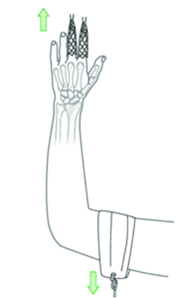 Spilling the Teacup: Lunate and Perilunate Dislocations — Kwak Talk