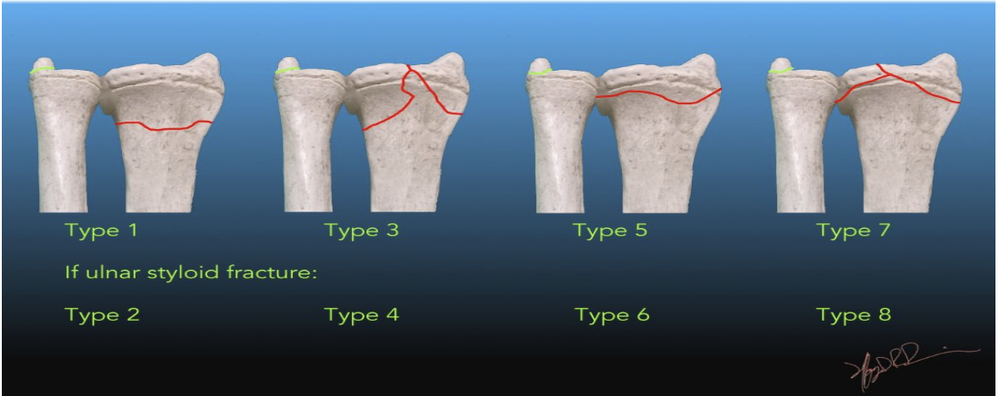 Distal Radius Fractures and Splinting — Kwak Talk