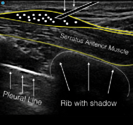 Serratus Anterior Block — Kwak Talk