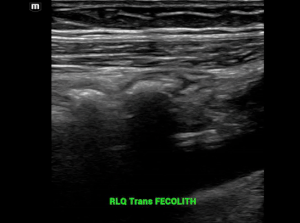 Appendix ultrasound — Kwak Talk