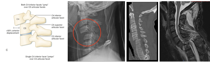 Unstable Cervical Spine Fractures — Kwak Talk