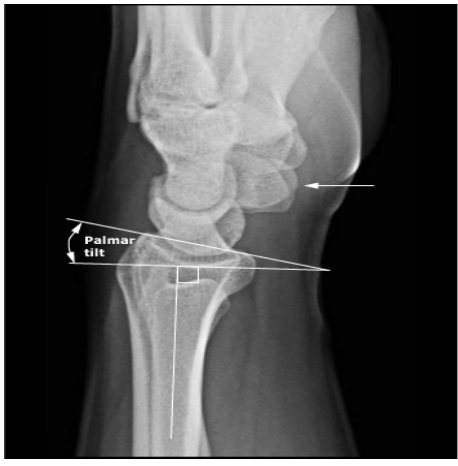 Distal Radius Fractures and Splinting — Kwak Talk