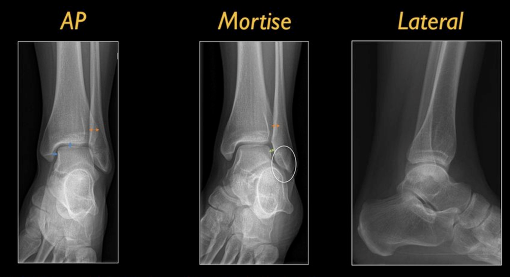 Ankle Fractures — Kwak Talk