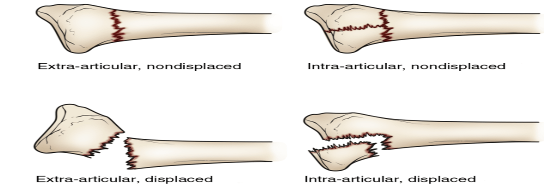 Distal Radius Fractures and Splinting — Kwak Talk