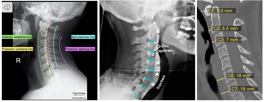 Unstable Cervical Spine Fractures — Kwak Talk