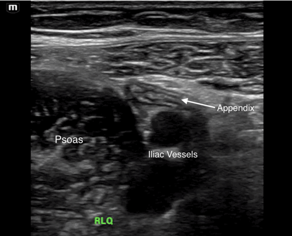 Appendix ultrasound — Kwak Talk