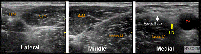 Fascia Iliaca Block — Kwak Talk