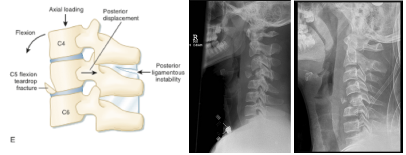 Unstable Cervical Spine Fractures — Kwak Talk