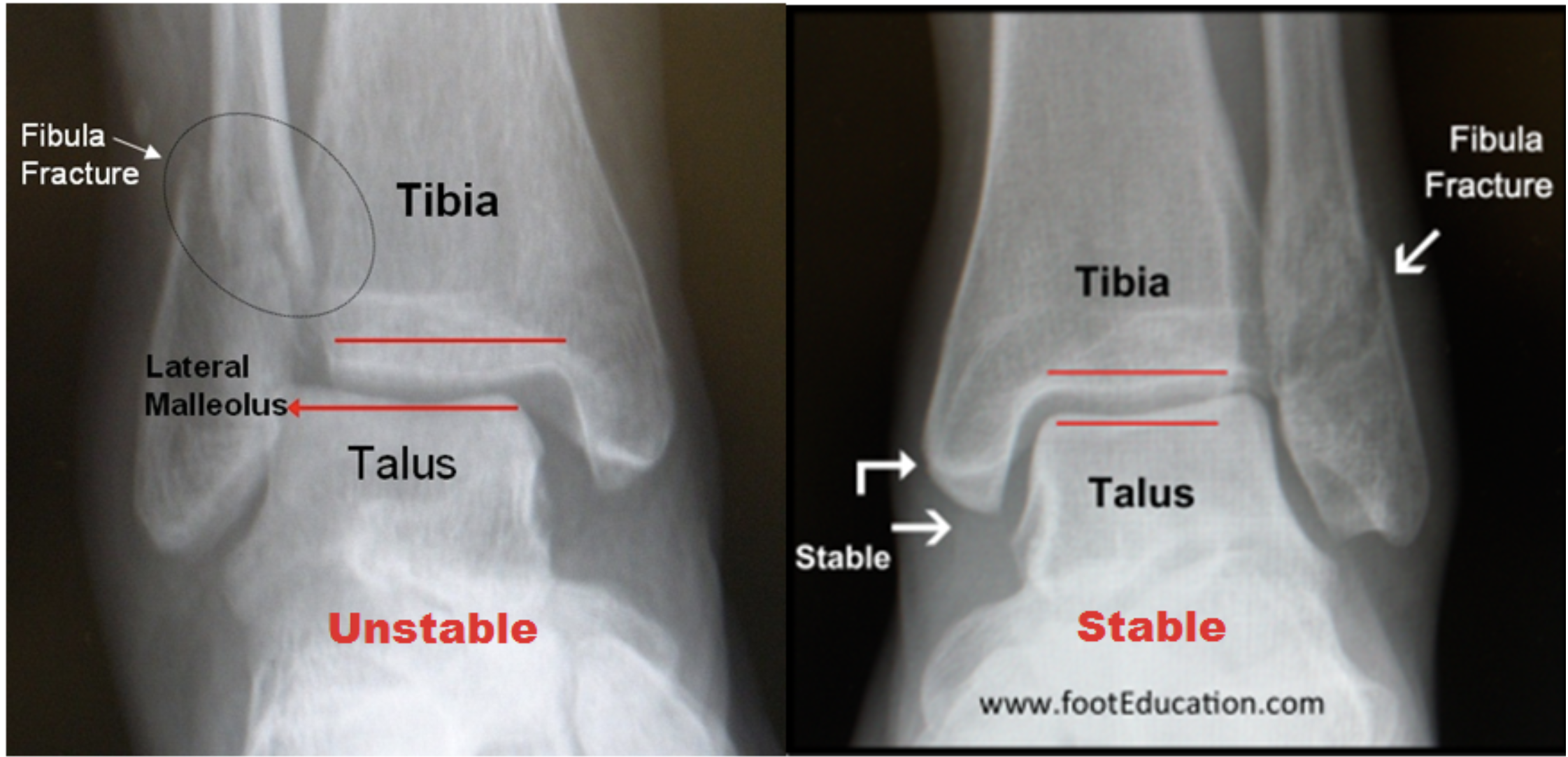 Ankle Fractures — Kwak Talk