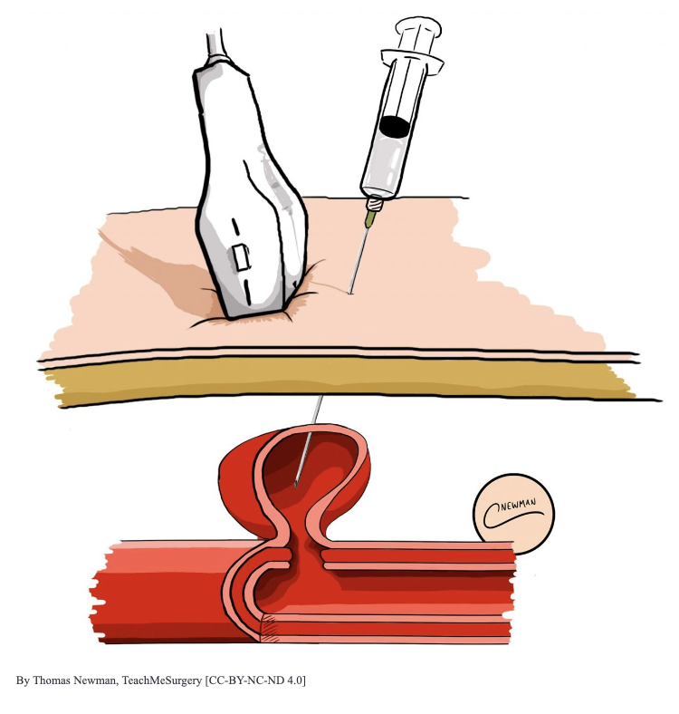 Pseudoaneurysm Post-Cardiac Catheterization — Kwak Talk