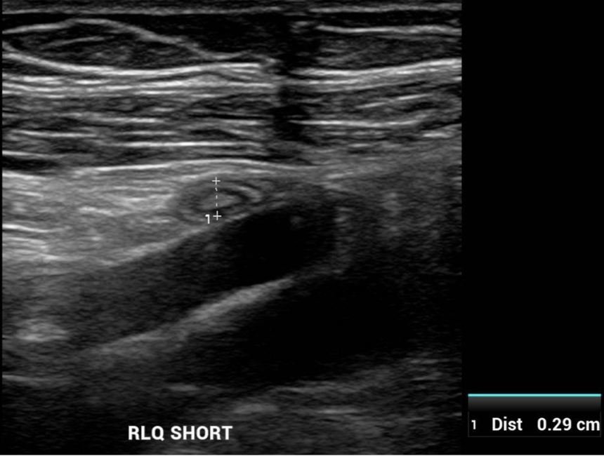 Appendix ultrasound — Kwak Talk