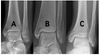 Weber Fractures — Kwak Talk