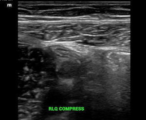 Appendix ultrasound — Kwak Talk