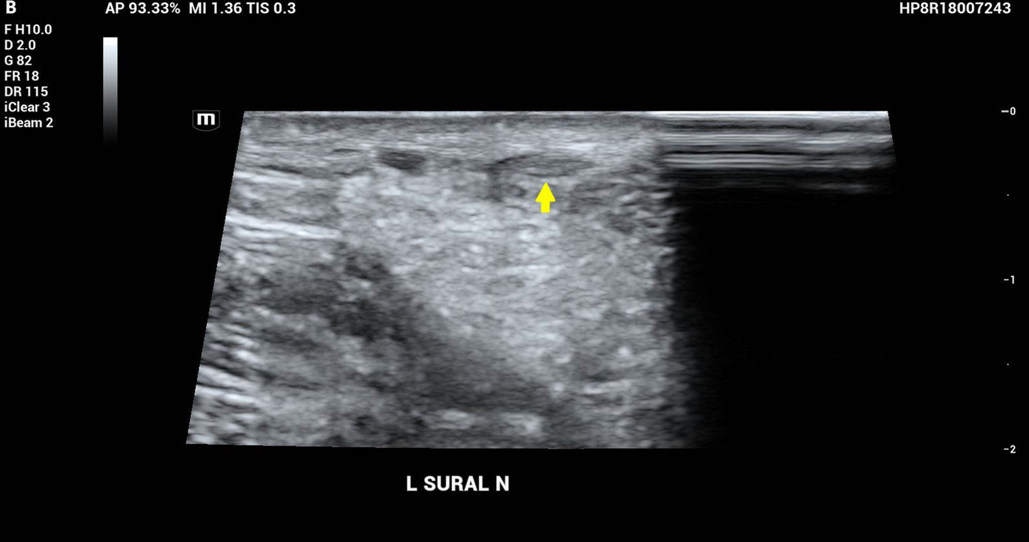 Posterior Tibial Nerve and Sural Nerve Block — Kwak Talk