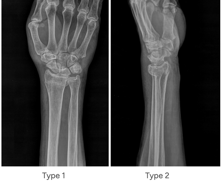 Distal Radius Fractures and Splinting — Kwak Talk