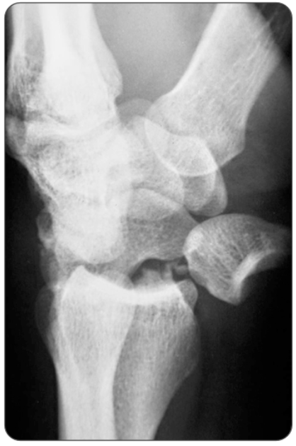 Spilling the Teacup: Lunate and Perilunate Dislocations — Kwak Talk