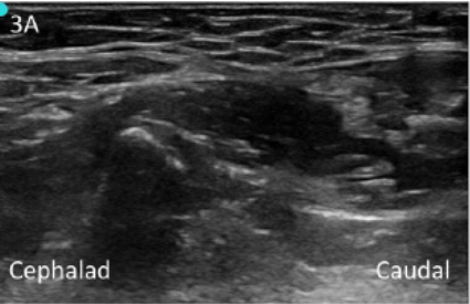 Fascia Iliaca Block — Kwak Talk
