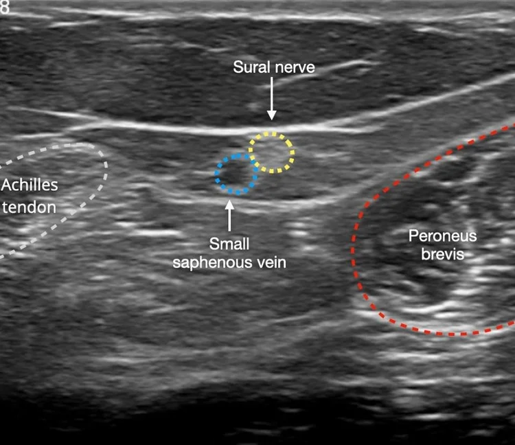 Posterior Tibial Nerve and Sural Nerve Block — Kwak Talk