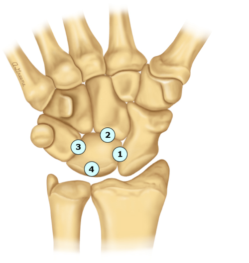 Spilling the Teacup: Lunate and Perilunate Dislocations — Kwak Talk
