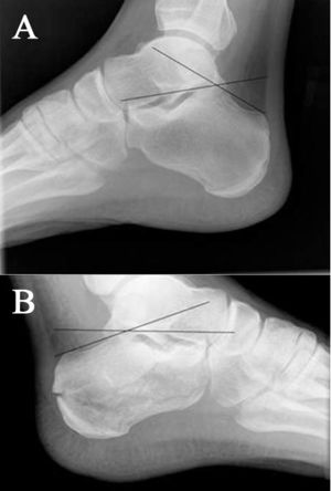 Calcaneus Fracture: The Lover’s Fracture — Kwak Talk
