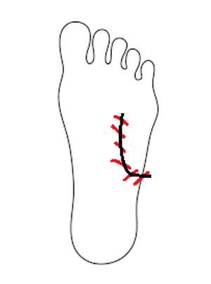 Posterior Tibial Nerve and Sural Nerve Block — Kwak Talk