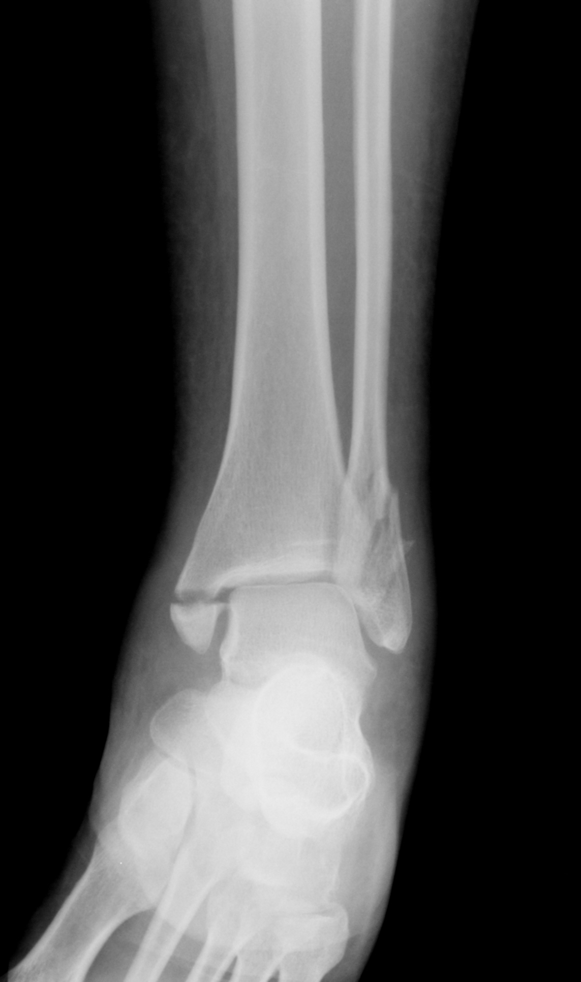 Ankle Fractures — Kwak Talk