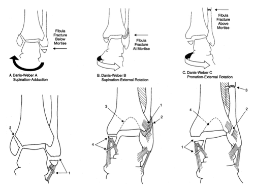 Weber Fractures — Kwak Talk