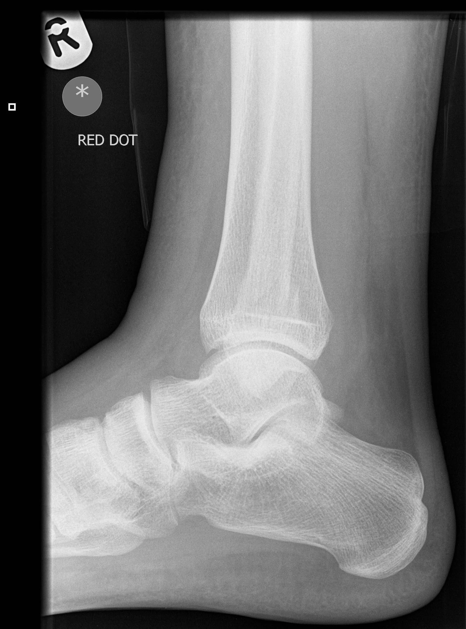Ankle Fractures — Kwak Talk