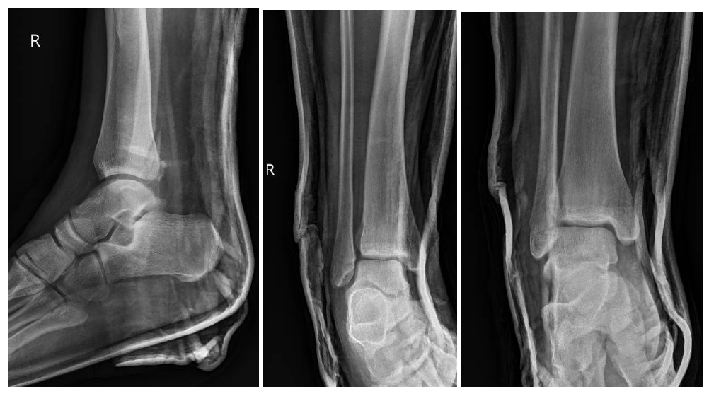 Swing and a Miss: Ankle Fracture Dislocations in the ED — Kwak Talk