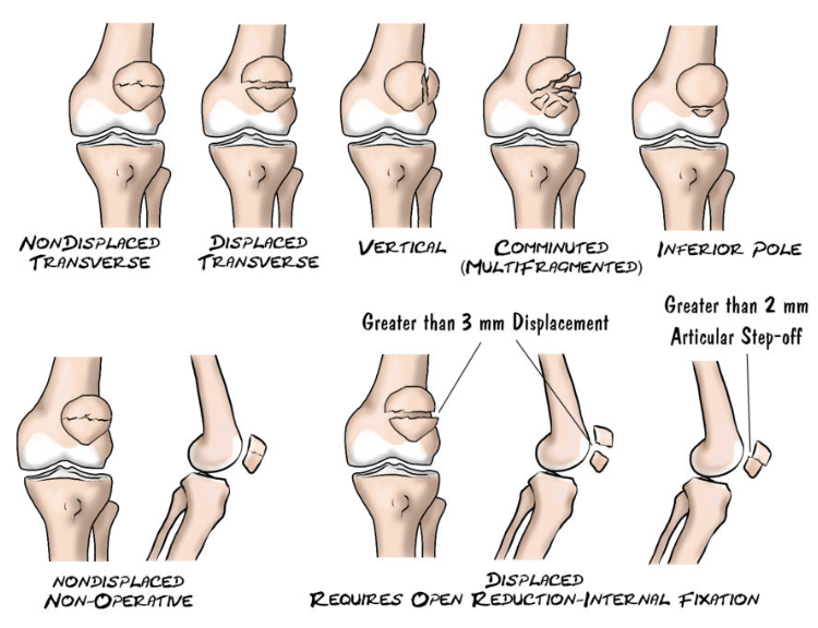 Patella Fracture — Kwak Talk