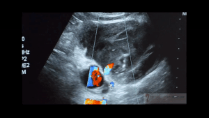 Pseudoaneurysm Post-Cardiac Catheterization — Kwak Talk