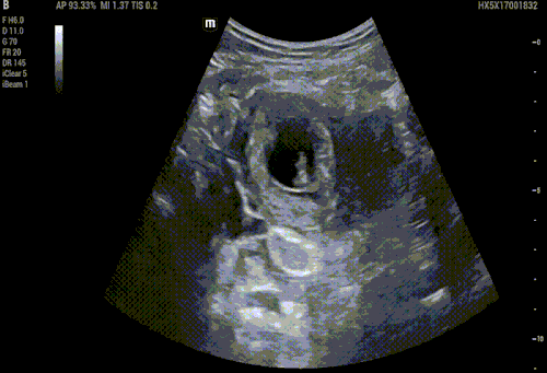 Oh MAN! - Interstitial Ectopic — Kwak Talk