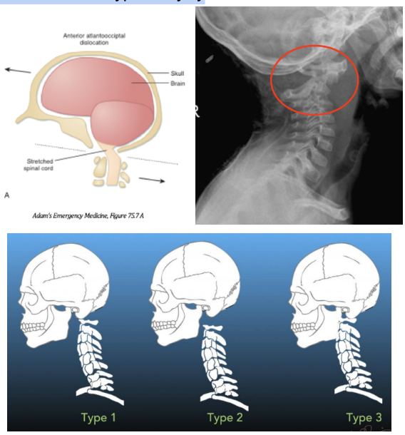Unstable Cervical Spine Fractures — Kwak Talk