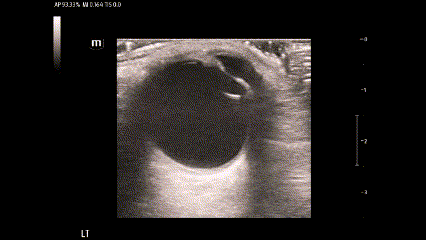 Retinal Detachment Ultrasound Gif